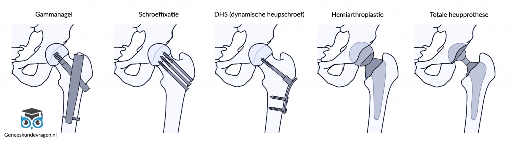 Proximale femurfracturen - Geneeskundevragen.nl