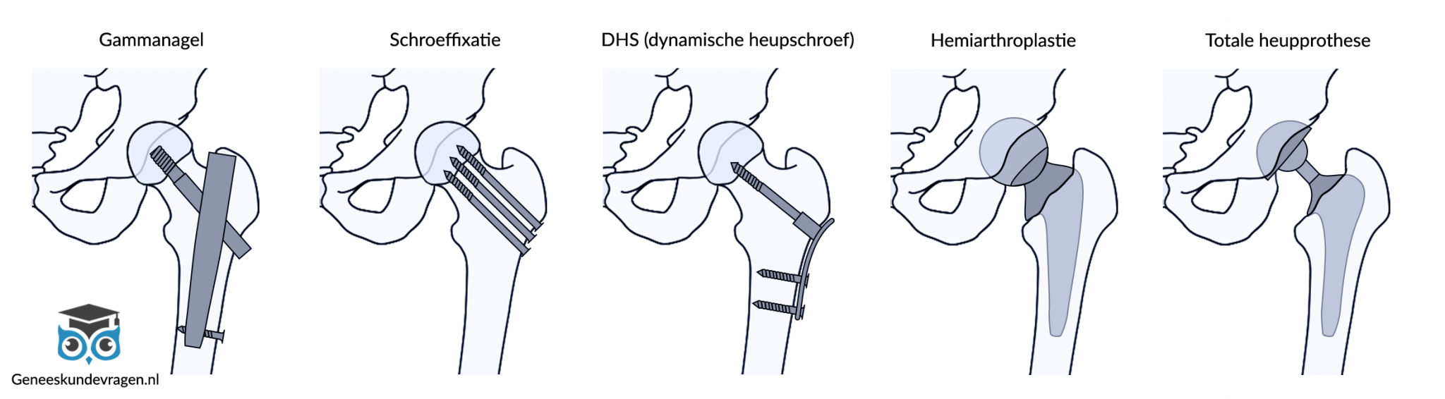 Proximale femurfracturen - Geneeskundevragen.nl